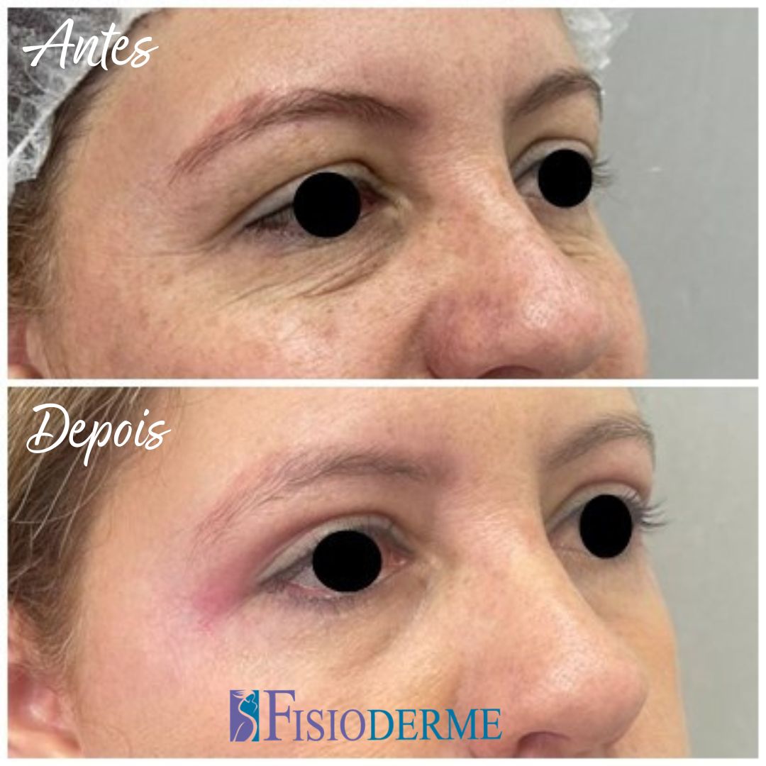 Line Skin Luminous para rejuvenescimento em Brasília